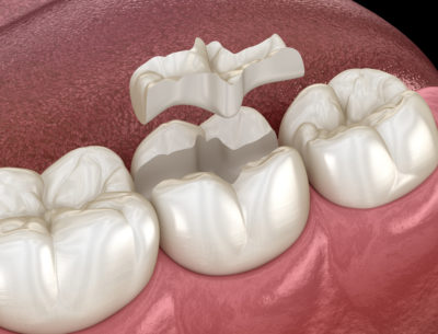 Zahn Inlay Onlay | Schwabing Zahnarzt